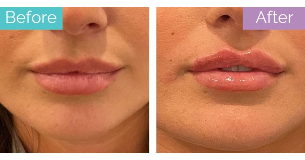 Migration Lip Filler Mustache: Causes, Fix, and Prevention